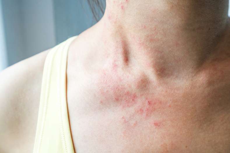 Hives & Angioedema - Causes, Diagnosis & Treatment
